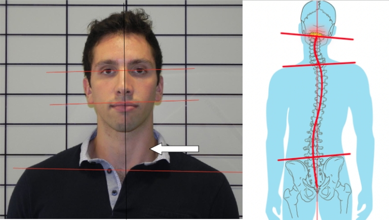 Fix Your Asymmetry Course – Welcome